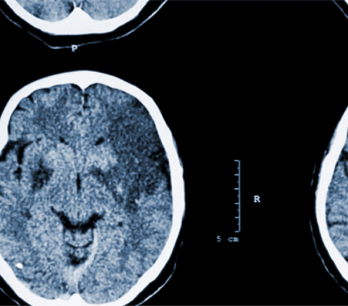 excellence in stroke | strokeforum.com